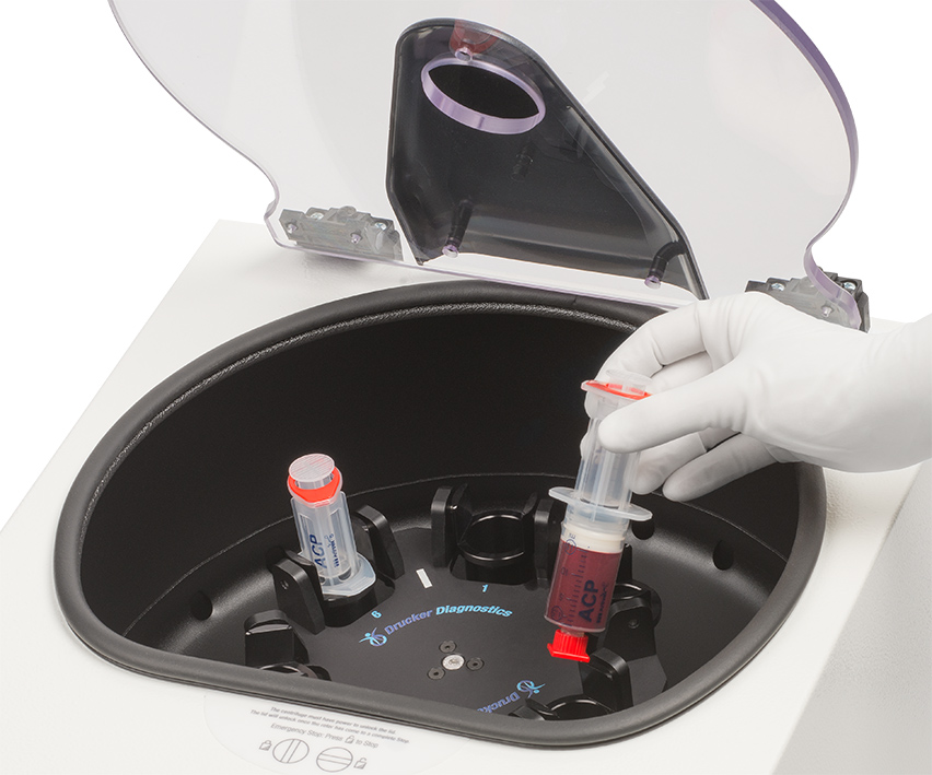 PRP & ACP bei Plantarfasziitis – platelet rich plasma kann zur Heilung ...