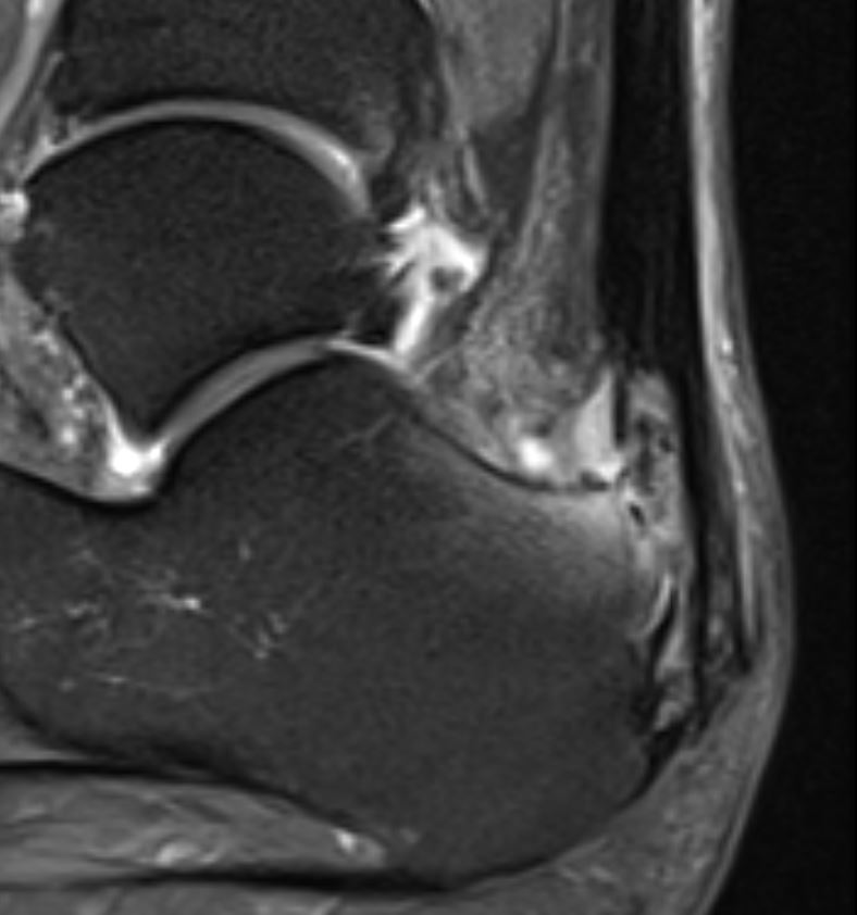 Haglund-Syndrom & Haglundferse | ORTHO | PEDE Zentrum für Fuß und ...