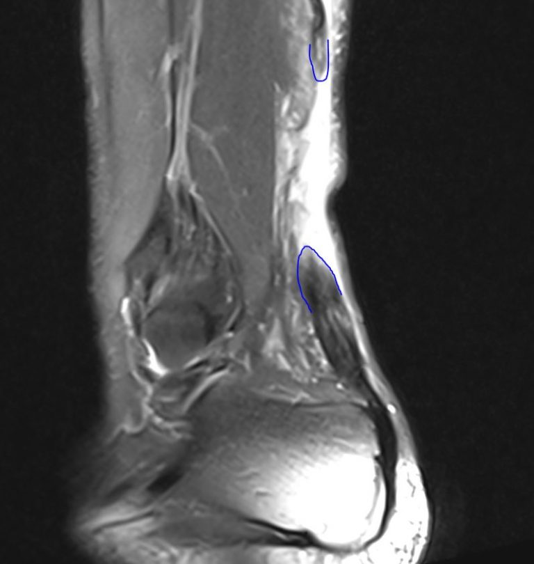 Achillessehnenruptur | ORTHO | PEDE Zentrum für Fuß und Sprunggelenk