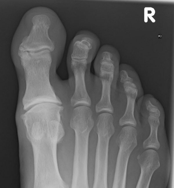 Arthrose der Großzehe (Hallux Rigidus) | ORTHO | PEDE Zentrum für Fuß ...