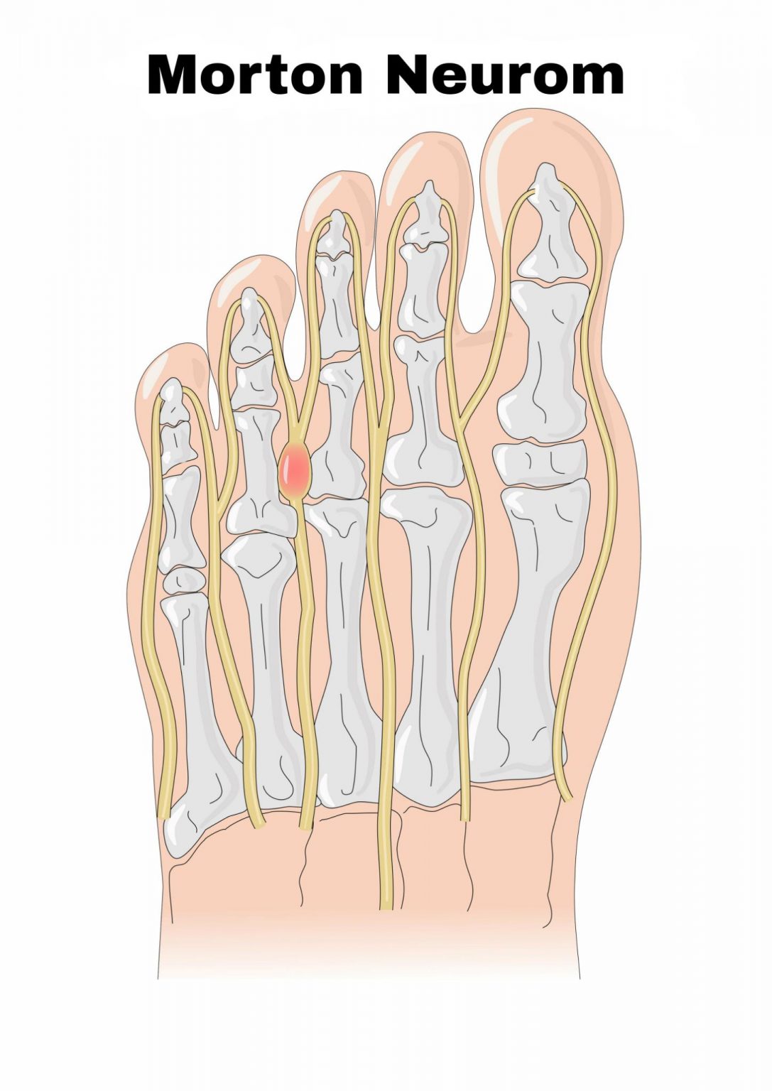 Morton Neurom – was Sie über Ihre Schmerzen wissen sollten | ORTHO ...