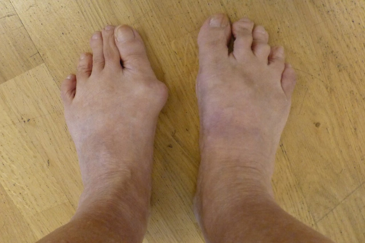 Chevron Osteotomie – sofort belastbare OP-Methode bei Hallux Valgus ...