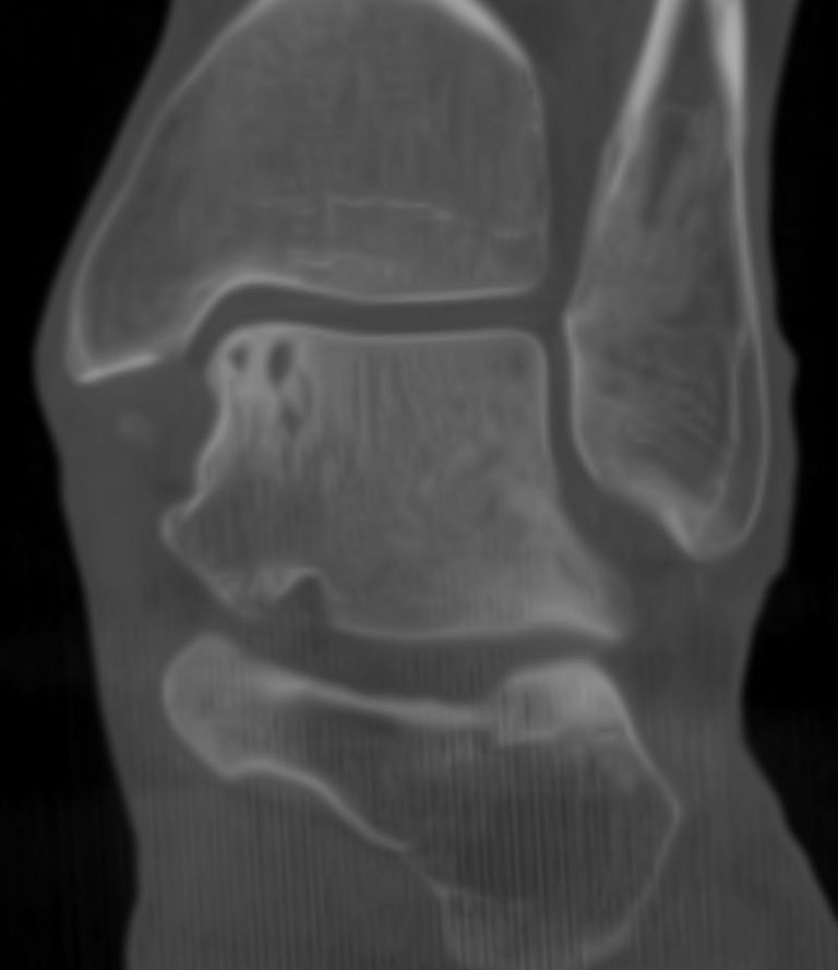Osteochondrale Läsion des Talus | ORTHO | PEDE Zentrum für Fuß und ...