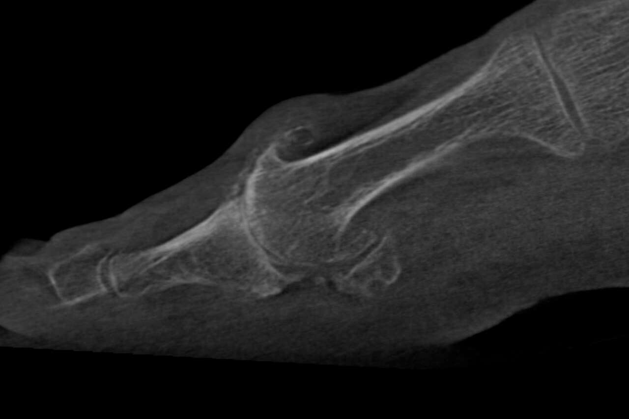 Arthrose der Großzehe (Hallux Rigidus) | ORTHO | PEDE Zentrum für Fuß ...