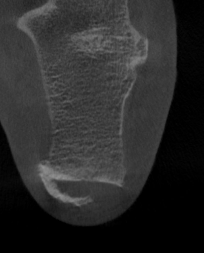 Haglund-Syndrom & Haglundferse – Diagnose, Therapie & OP