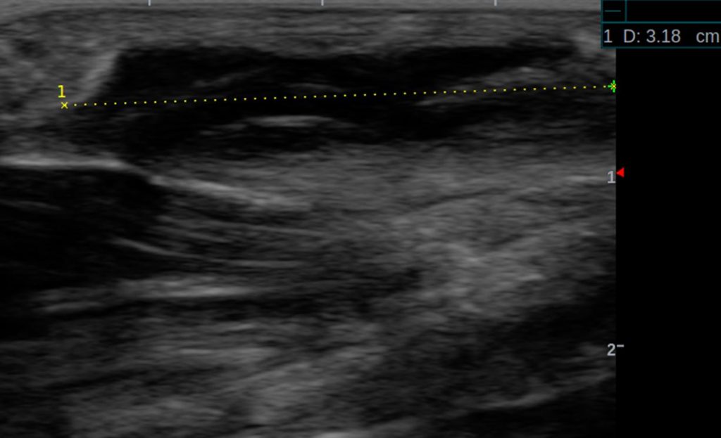 Morbus Ledderhose | ORTHO | PEDE Zentrum für Fuß und Sprunggelenk