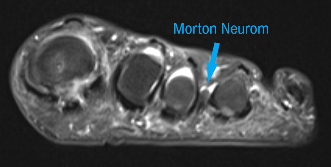 Morton Neurom