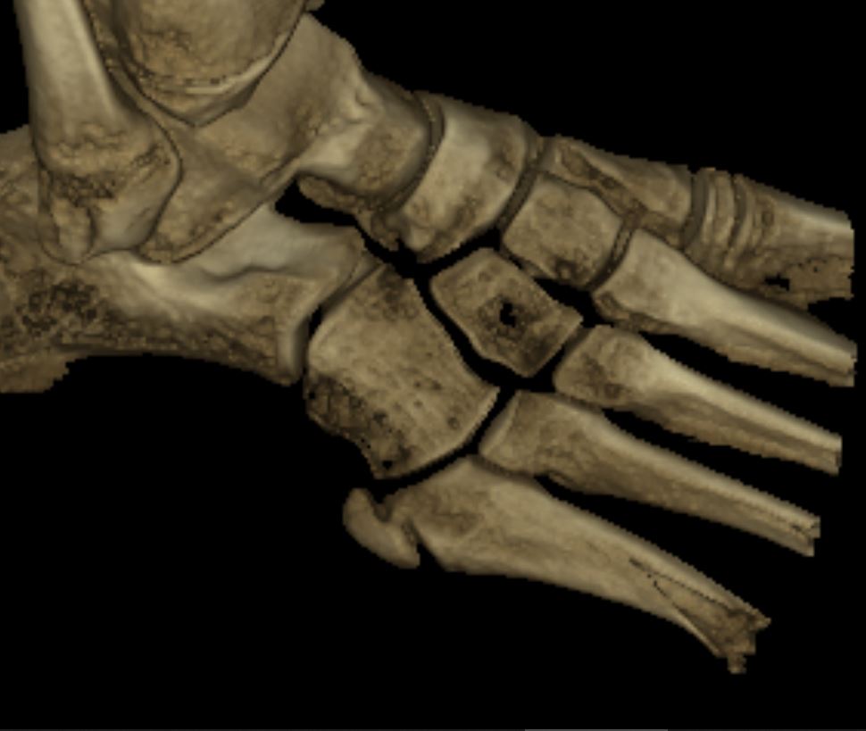 Morbus Iselin – Traktionsapophysitis der Metatarsale 5 Basis | ORTHO ...