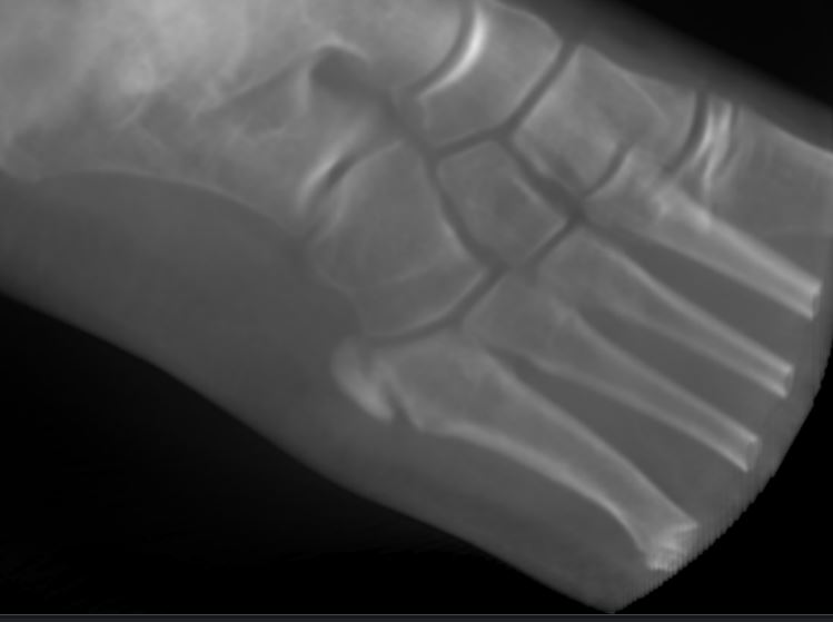 Morbus Iselin – Traktionsapophysitis der Metatarsale 5 Basis | ORTHO ...