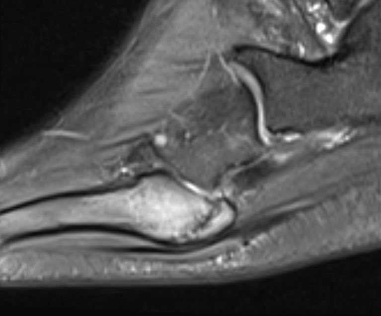 Morbus Iselin – Traktionsapophysitis der Metatarsale 5 Basis | ORTHO ...