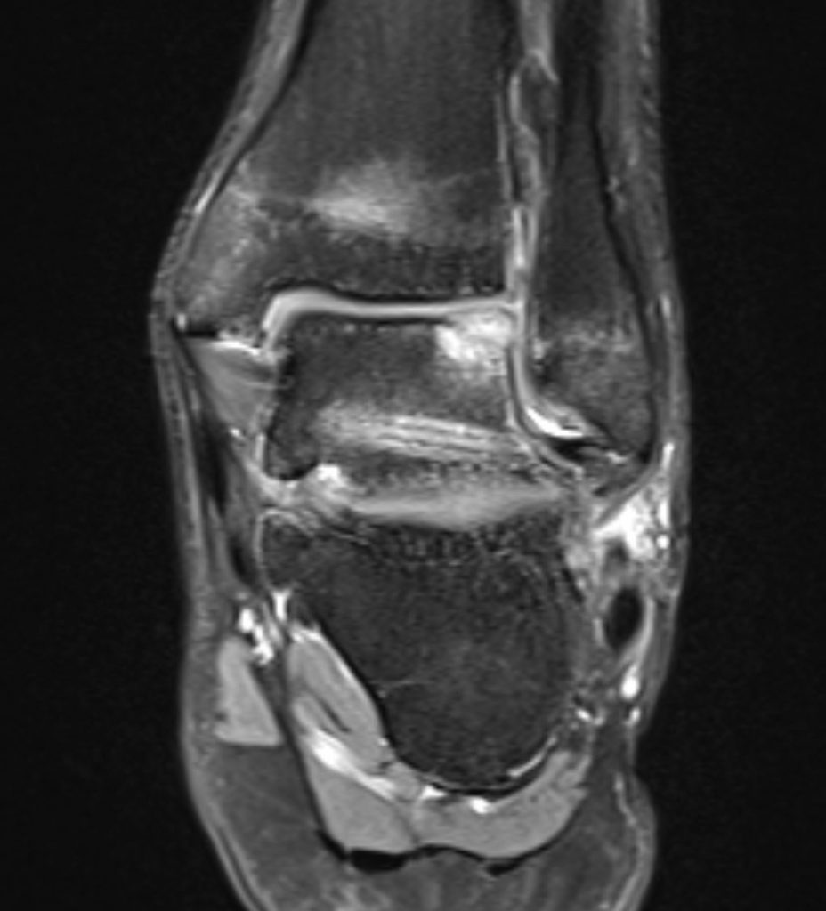 Osteochondrale Läsion des Talus | ORTHO | PEDE Zentrum für Fuß und ...