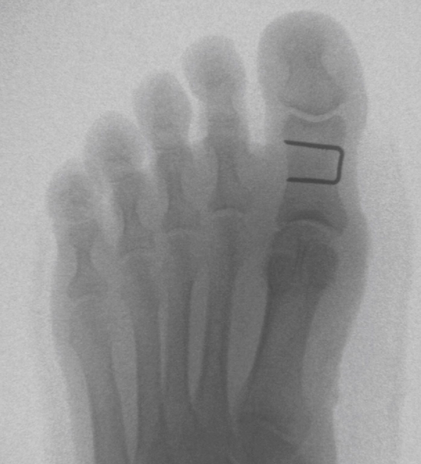 Arthrose der Großzehe (Hallux Rigidus) | ORTHO | PEDE Zentrum für Fuß ...