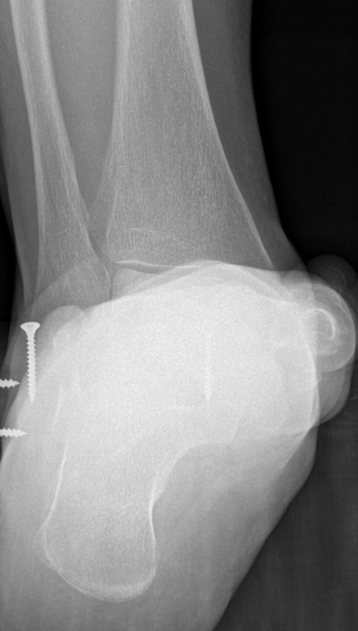 Saltzman Aufnahme richtig machen – Tipps und Tricks vom Fußspezialisten ...