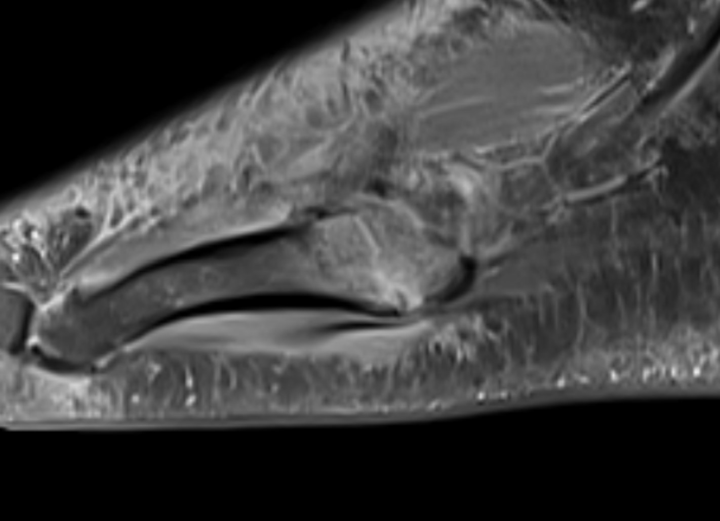 Knochenbruch Mittelfuß | ORTHO | PEDE Zentrum für Fuß und Sprunggelenk