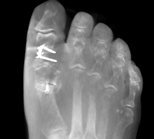 Arthrose der Großzehe (Hallux Rigidus) | ORTHO | PEDE Zentrum für Fuß ...