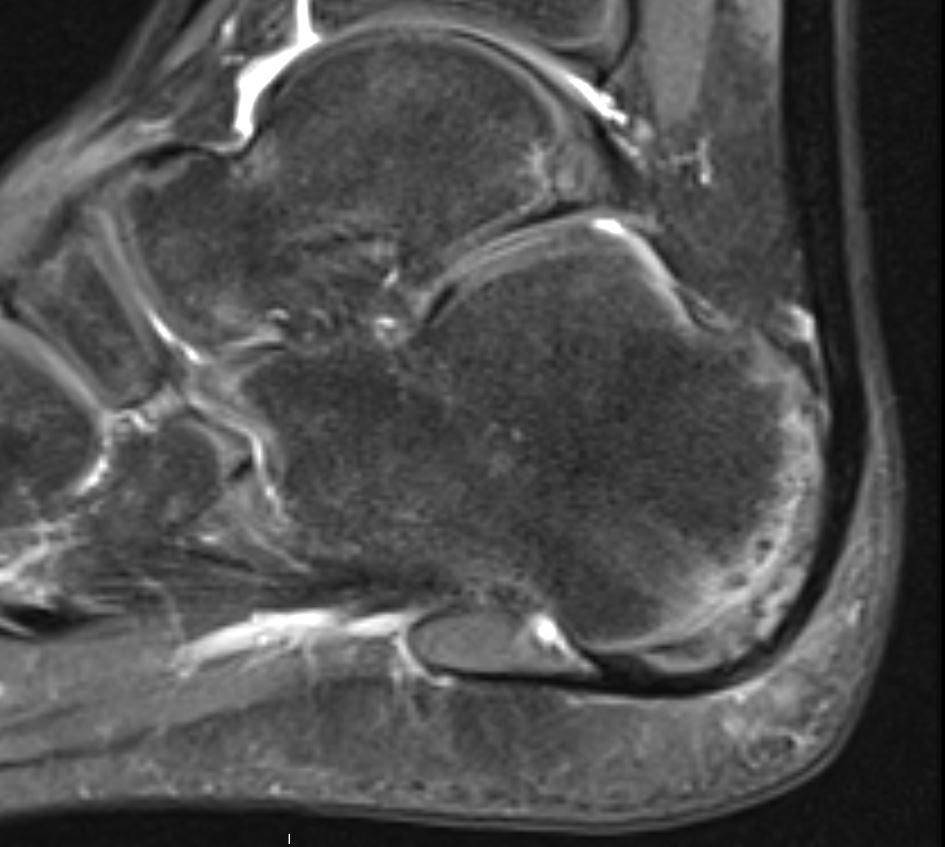 Apophysitis calcanei – Morbus Sever | ORTHO | PEDE Zentrum für Fuß und ...