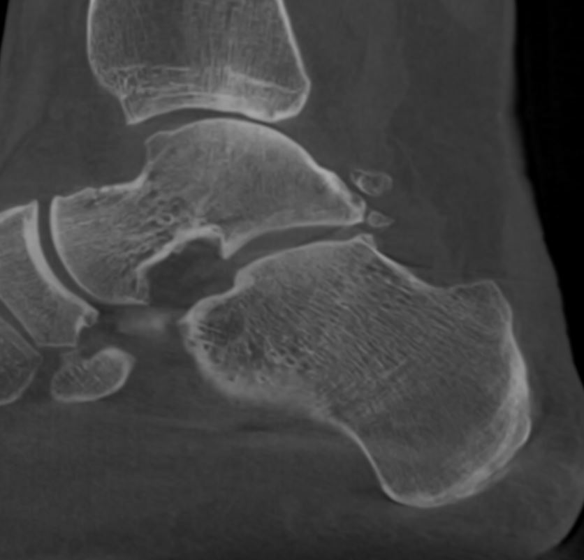 Os Trigonum Syndrom | ORTHO | PEDE Zentrum für Fuß und Sprunggelenk