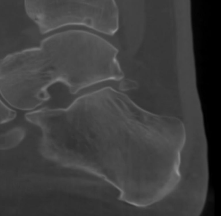 Os Trigonum Syndrom | ORTHO | PEDE Zentrum für Fuß und Sprunggelenk