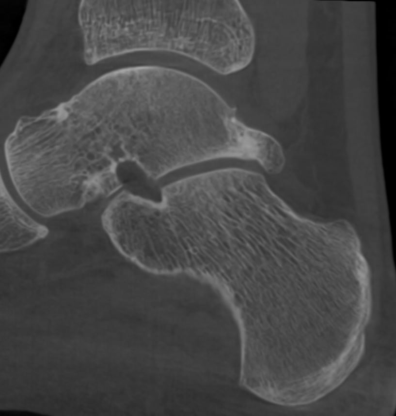 Os Trigonum Syndrom | ORTHO | PEDE Zentrum für Fuß und Sprunggelenk