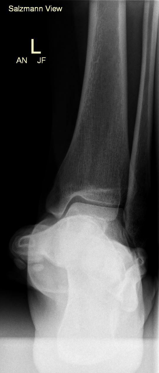 Saltzman Aufnahme richtig machen – Tipps und Tricks vom Fußspezialisten ...